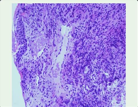 Histopathological Findings Of The Subglottic Lesion Biopsy Specimen