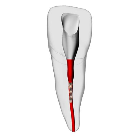 Incisor Broken File Dental Training Models Drsk