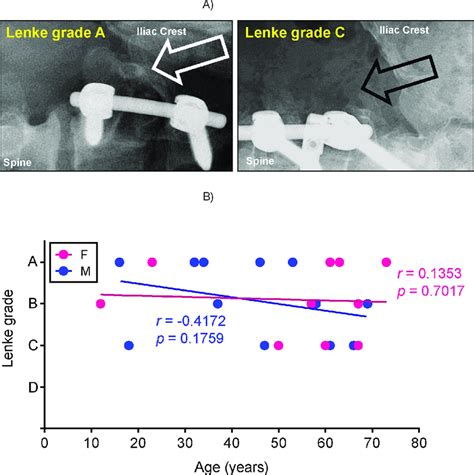 Radiographic Lenke Grade Does Not Correlate With Patient Age A At 12