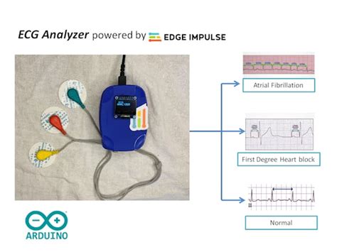 Need Advise Ecg Analyzer Help Edge Impulse Forum