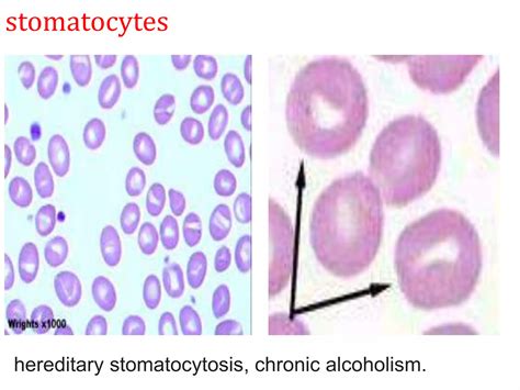 Anemia Classification Cf Lab Diagnosis Ppt