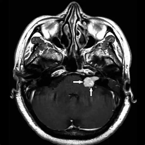 Mri Temporal Bone Test Price In Delhi Ganesh Diagnostic