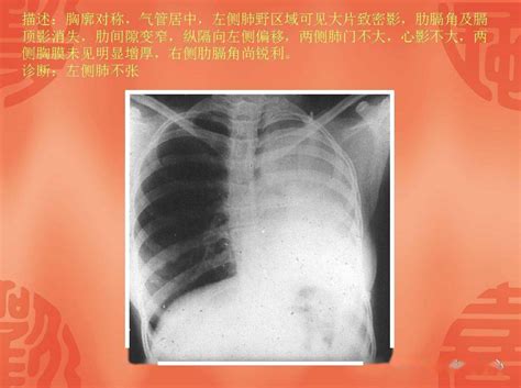 X线入门 初学者一定要记住的32张平片!描述诊断 搜狐大视野 搜狐新闻 X线入门 初学者一定要记住的32张平片!描述诊断 搜狐大视野 搜狐新闻