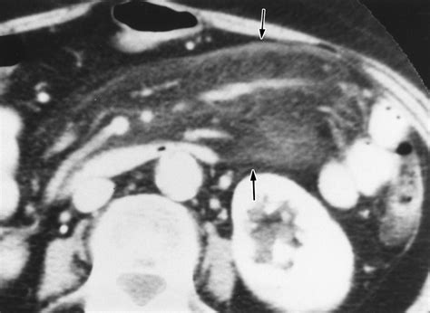 Ct Evaluation Of Mesenteric Panniculitis Prevalence And Associated