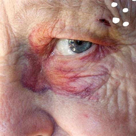 What Is A Hematoma Symptoms Diagnosis And Treatment