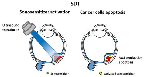 An Illustration Of Sonodynamic Therapy This Technology Was Developed