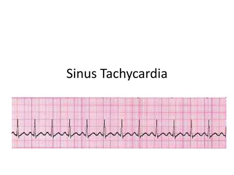 Sinus Tachycardia Pptx