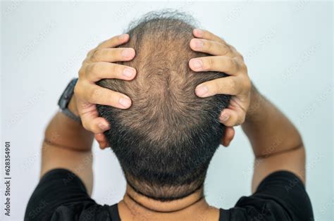 Rear View Of Bald Spot On Mens Head Baldness Is Related To Your Genes