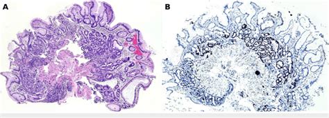 Hyperplasia Of Gastric Enterochromaffin Like Ecl Cells A Gastric