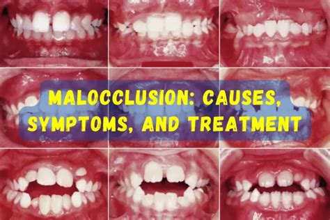 Malocclusion Causes Symptoms And Treatment