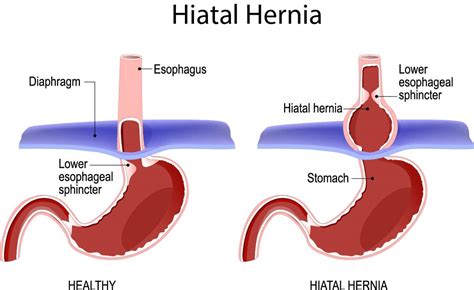 Lower Esophageal Sphincter Repair