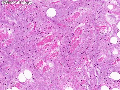 Spindle Cell Lipoma Myxoid Stroma