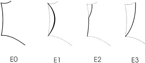 Glenoid Bone Grafting With A Reverse Design Prosthesis Journal Of