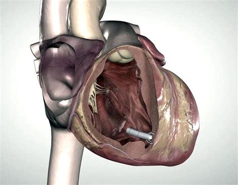 Medtronic Developing New Mini Pacemaker Mpr News