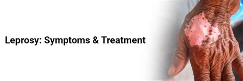 Leprosy Symptoms And Treatment