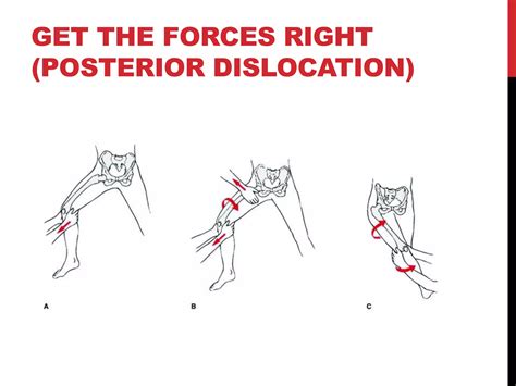 Hip Reduction Techniques Pptx