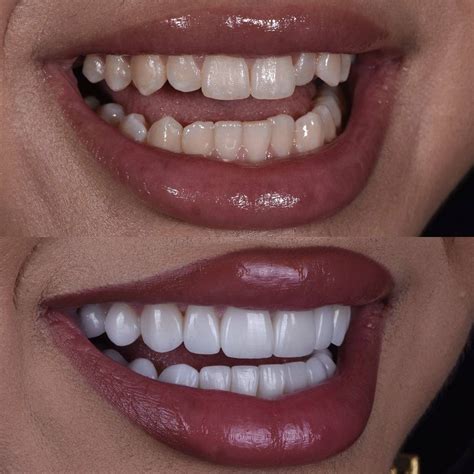 Veneers For Crowded Teeth Misalignment Smiles By Dr P Veneers