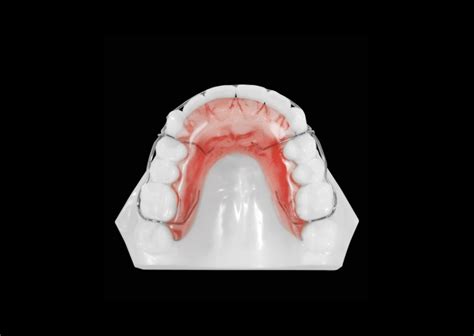 Circumferential Retainer Universal Orthodontic Lab