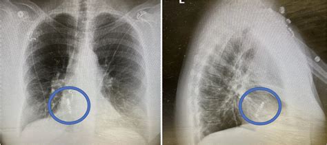 A Pa And Lateral Chest Radiograph Demonstrates The Leadless Pacemaker