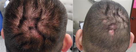 Cutis Verticis Gyrata Cause Traitement Symptôme Cest Quoi Ghtizr