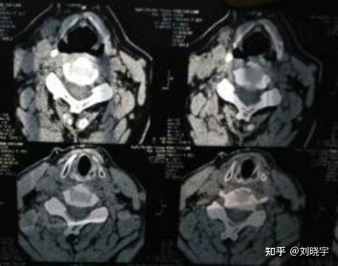 图解——最全的颈椎ct临床表现，颈椎影像全搞定 知乎