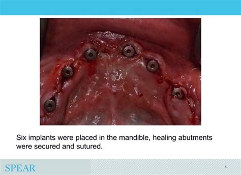 Conversion Prosthesis For An Implant Supported Fixed Dental Prosthesis