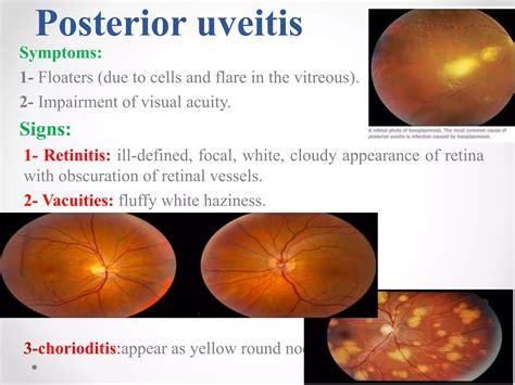 Uvitis Opthalomology Pptx