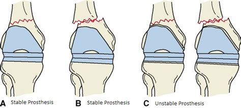Tka Periprosthetic Fracture Recon Orthobullets