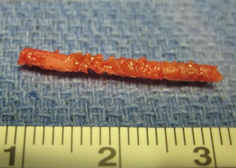 Bone Marrow Core Biopsy