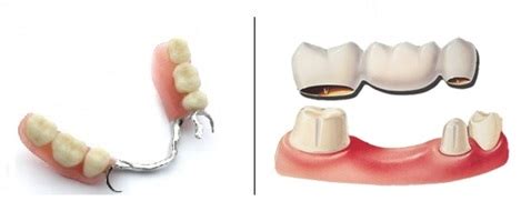Bridges Vs Partial Dentures Which Is Right For You