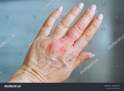 Red Wasp Sting Swelling Wasp Sting Heres What You Need To Know