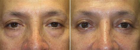 Lower Blepharoplasty Dark Circles Treatment Tear Trough