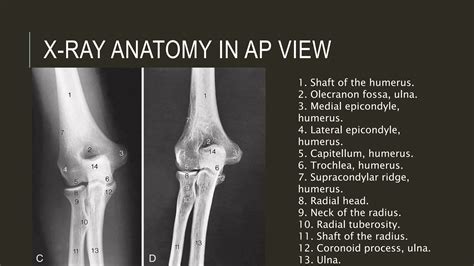 X Ray Of Elbow Joint Pptx