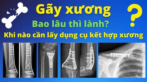 Gãy Xương Bao Lâu Thì Lành Thời Gian Phục Hồi Và Lưu Ý Quan Trọng