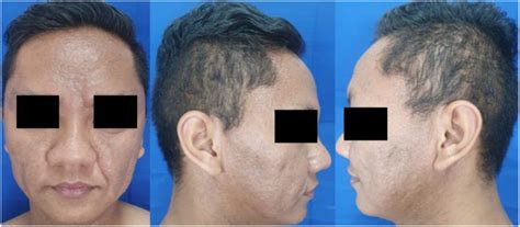 Cutis Verticis Gyrata In A Patient With Familial Presenile Sebaceous