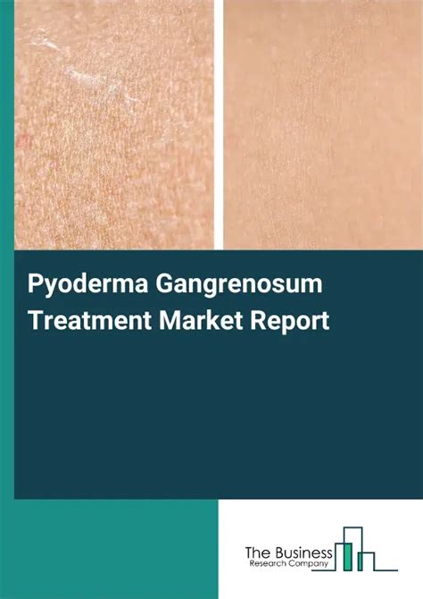 Pyoderma Gangrenosum Treatment Market Share Size Report 2035
