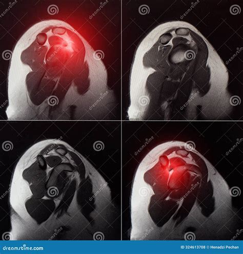 Mri Image Of The Shoulder Joint After A Fracture And Dislocation