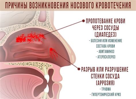 Как укрепить сосуды в носу, чтобы не шла кровь