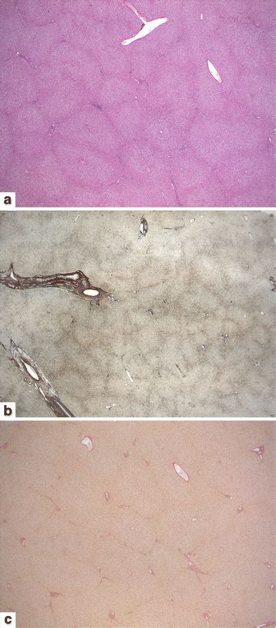 Nodular Regenerative Hyperplasia A Nodularity Is Easily Appreciated Download Scientific
