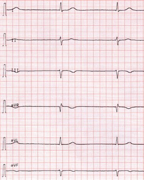 Junctional Bradycardia Sinus Bradycardia Definitions Ecg Causes And