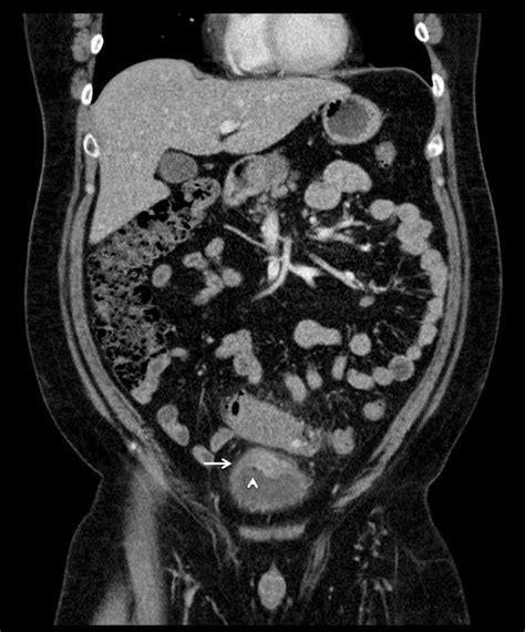 Diverticulitis Abscess