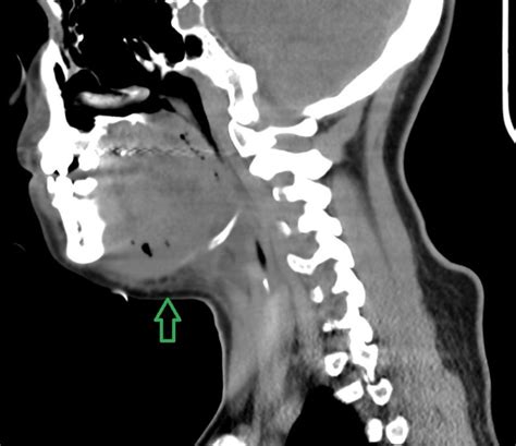 Ludwigs Angina Radiologia Ludwig Angina Radiology Case