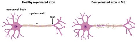 Multiple Sclerosis Neuron