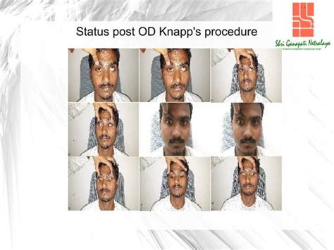 Monocular Elevation Deficit With Pellucid Marginal Degeneration A Case