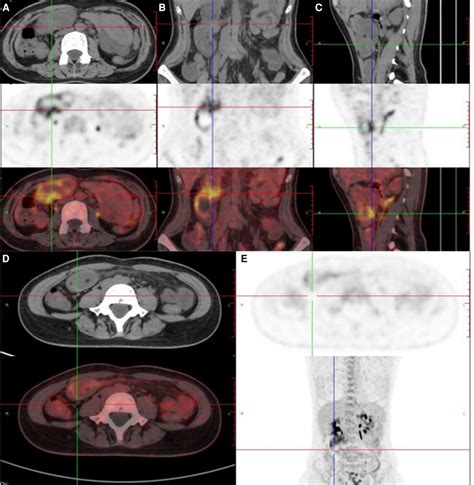 A C 18f Fdg Positron Emission Tomography Computed Tomography Showed