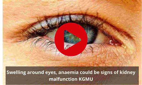 Limbic Sparing Conjunctivitis