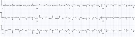 Ecg Cases 41 Stemi Occlusion Mi Complications