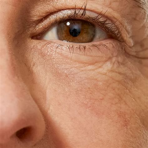 Understanding Wrinkles Causes Prevention And Management Skin Clinics