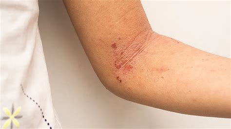 Itchy Rash Inside Elbow Crease Baeh