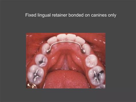 Retention In Orthodontics Ppt